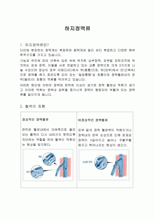 [분석/조사] 하지정맥류