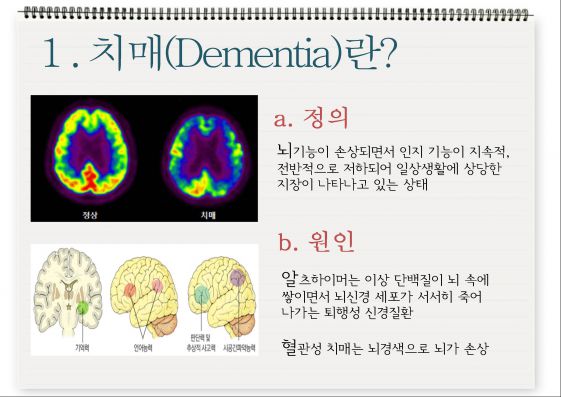 [학술제] 치매(Dementia).ppt