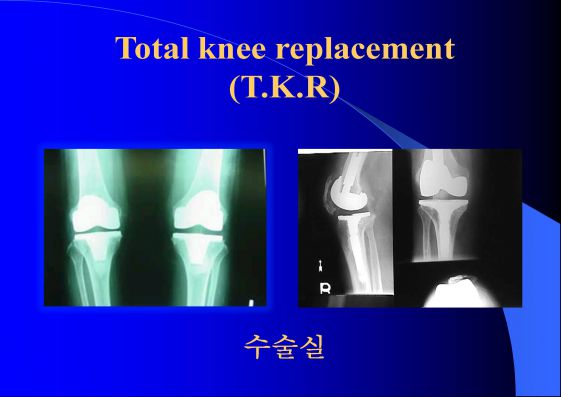 TKR(Total Knee Replacement)슬관절 대치술 PPT