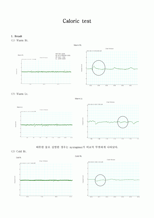 Caloric test 실습보고서 by