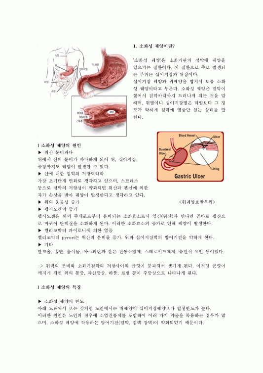 소화성 궤양에 대해