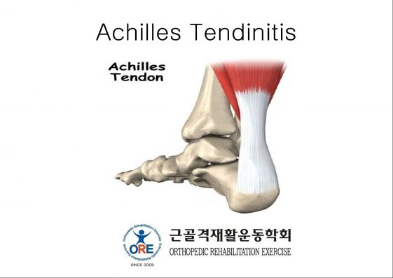 아킬레스 건염 재활 운동 (Achilles Tendinitis 정의, 원인, 진단, 분류, Paratenonitis(건주위염)치료, Tendinosis(퇴행성 건염) 치료, Achilles Tendon Rupture 정의, 증상, 아킬레스건 수술, 재활 운동).PPT자료