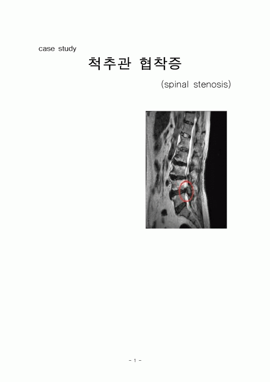 spinal stenosis 레포트 자료