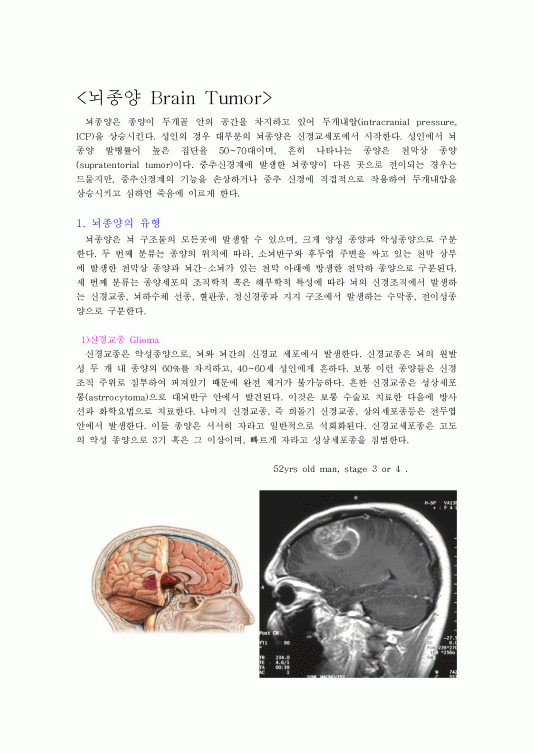 Brain _ tumor 레포트 자료