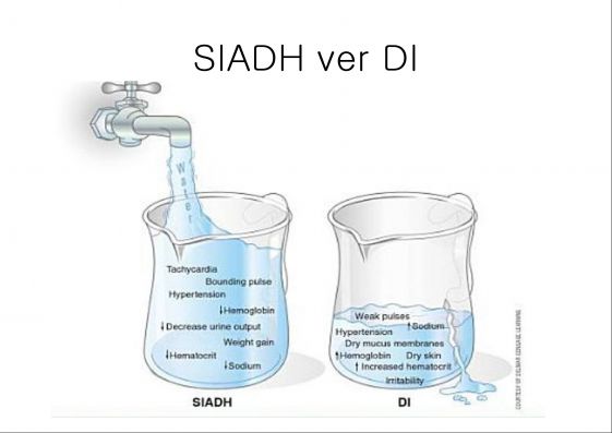 SIADH 와 DI 비교 ppt