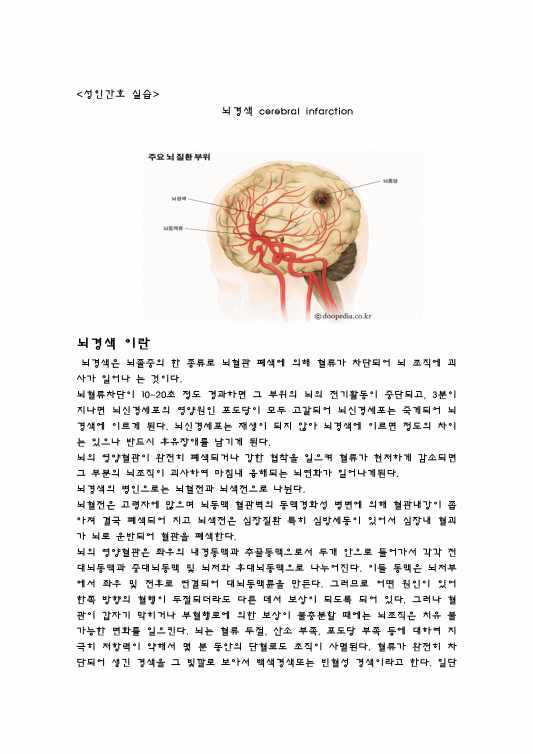 성인간호학 실습 - 뇌경색 (cerebral infarction) 조사