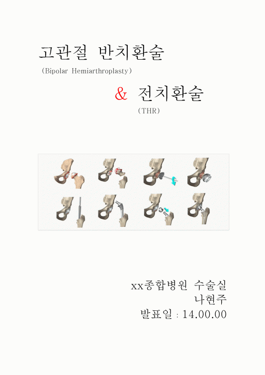 고관절 반치환술 (Bipolar Hemiarthroplasty) & 전치환술 (THR)