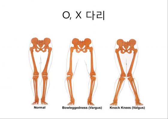 0 & X 다리의 이해 및 운동運動 방법