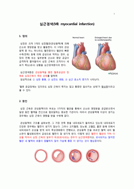 심근경색(MI: myocardial infarction)
