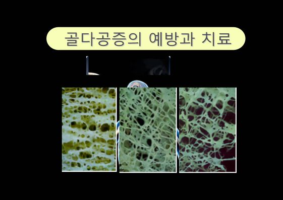 골다공증의 예방과 치료