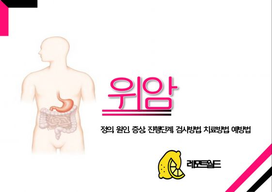 위암 - 정의, 원인, 증상, 진행단계, 검사방법, 치료방법, 예방법