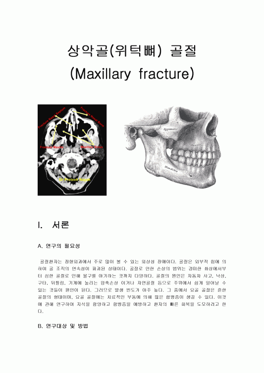 상악골 골절(위턱뼈 골절) 케이스(연구의 필요성부터 ~ 문헌고찰,간호과정, 간호사정, 간호진단, 느낀점)