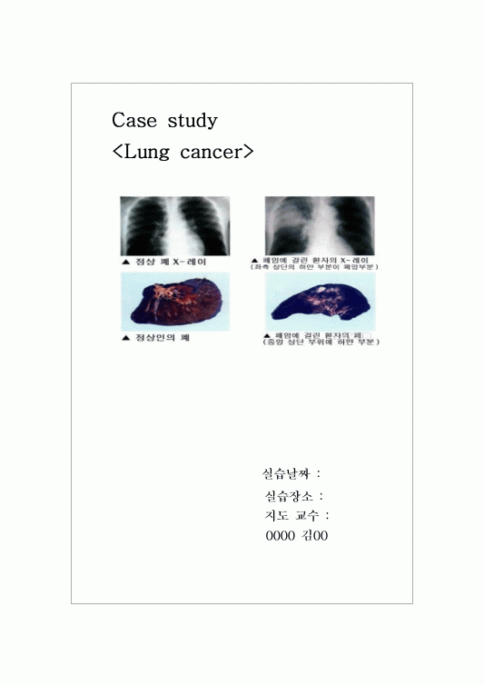 폐암 케이스(문헌고찰,병태생리,간호과정,간호사정,간호진단 포함)