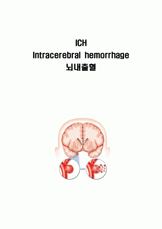 ICH Intracerebral hemorrhage 뇌내출혈 케이스, ICH 케이스 스터디, ICH 간호과정, 뇌내출혈 케이스, 뇌내출혈 간호과정,
