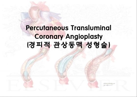 PTCA (경피적 관상동맥 성형술)