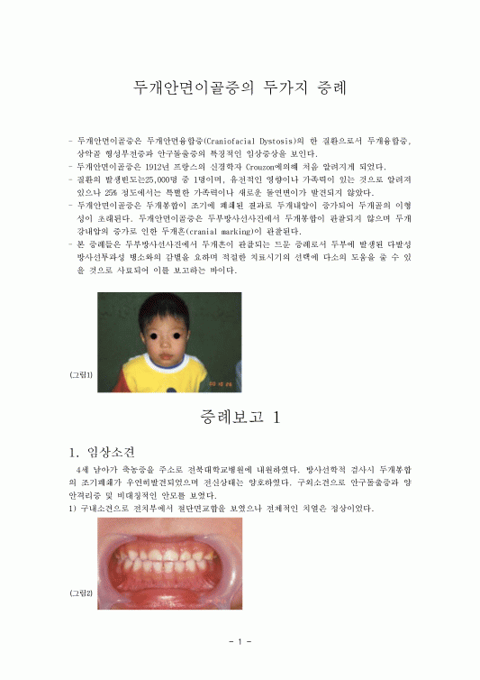 두개안면이골증의 두가지 증례