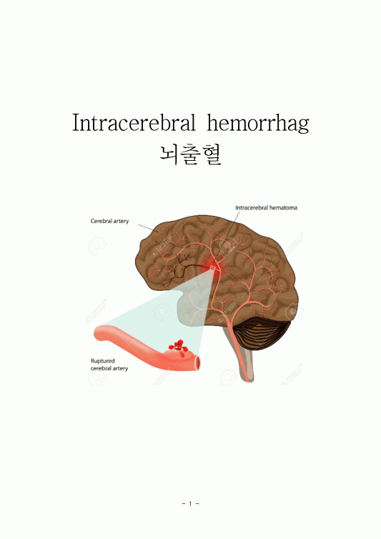 뇌출혈 cerebral hemorrhage