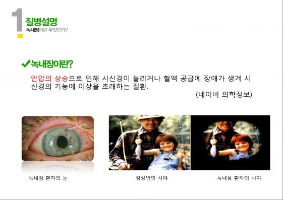 녹내장이란,안압이란,안압의상승