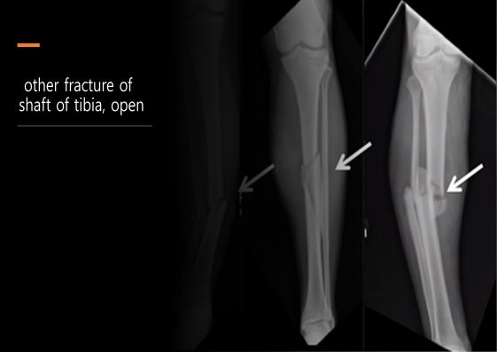 경골골절케이스 / other fracture of shaft of tibia, open / 근골격계 케이스